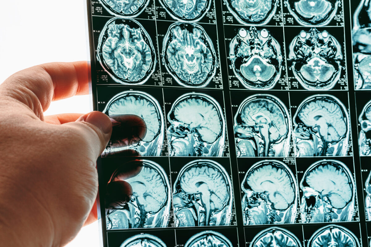 TeleNeurology | Access Telecare